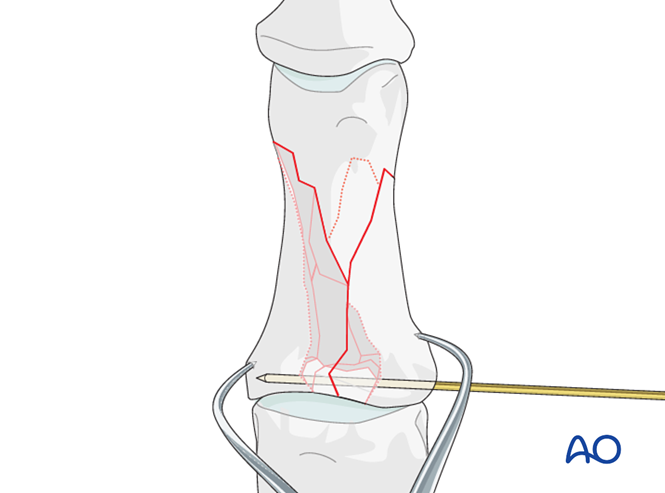 Open reduction, internal fixation (ORIF) for Proximal phalanx, base and ...