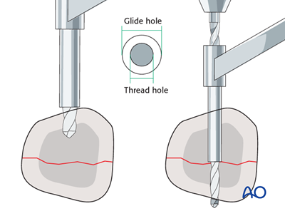 Open reduction, internal fixation (ORIF) for Proximal phalanx, base and ...