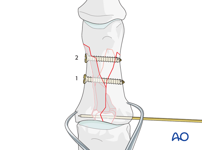 Open reduction, internal fixation (ORIF) for Proximal phalanx, base and ...