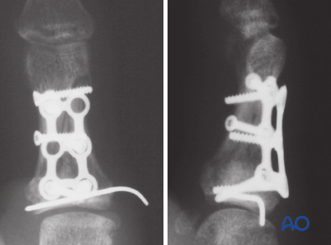 Open reduction, internal fixation (ORIF) for Proximal phalanx, base and ...