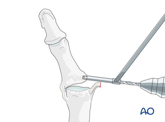 Ligament reattachment with suture anchors for Proximal phalanx, base ...