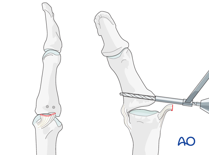 Ligament reattachment with suture anchors for Proximal phalanx, base ...