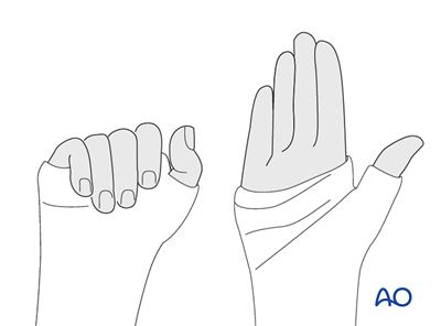 Nonoperative treatment for Metacarpal, Rolando fracture