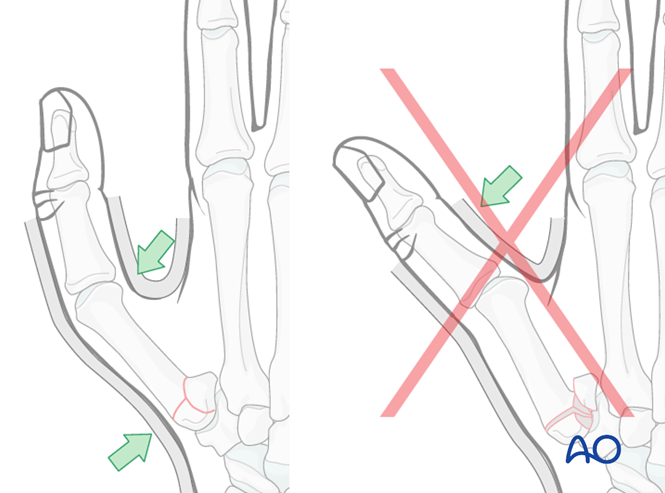 Nonoperative treatment for Metacarpal, Rolando fracture