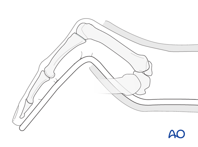 Nonoperative treatment for Proximal phalanx, articular (head), oblique