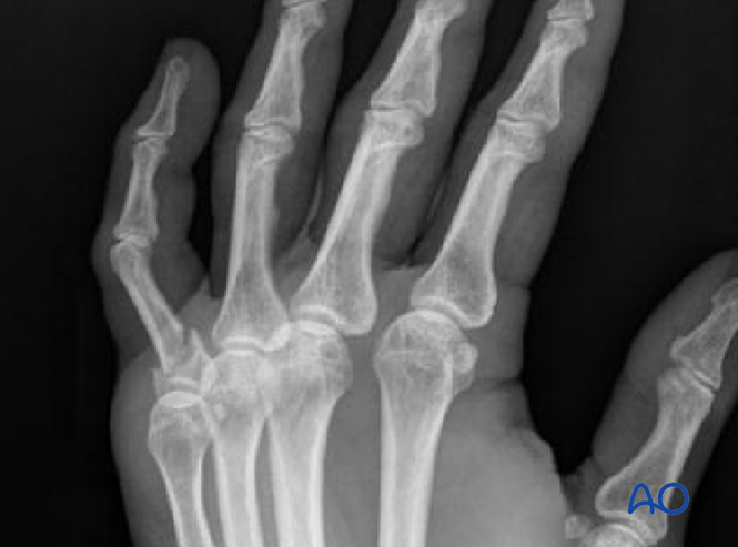Nonoperative treatment for Proximal phalanx, metaphyseal (head ...