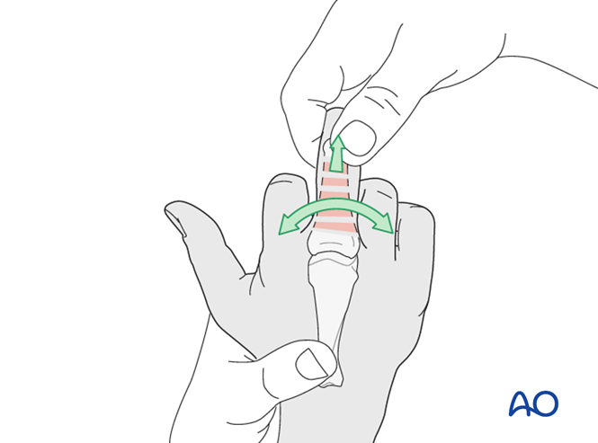 Nonoperative treatment for Proximal phalanx, metaphyseal (head ...