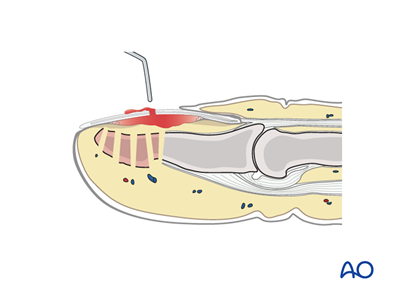 Nonoperative treatment for Distal phalanx, distal and shaft, transverse