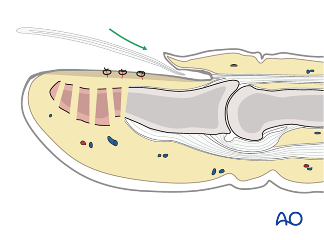 Nonoperative treatment for Distal phalanx, distal and shaft, transverse