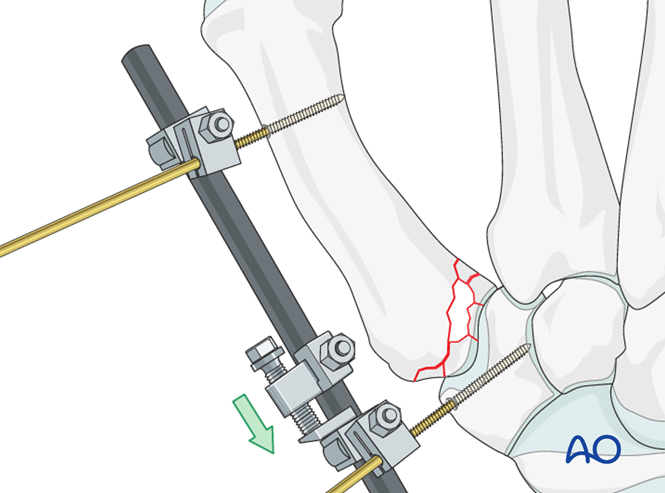 External fixation for Metacarpal, base