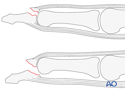 Dorsal approach to the DIP joint