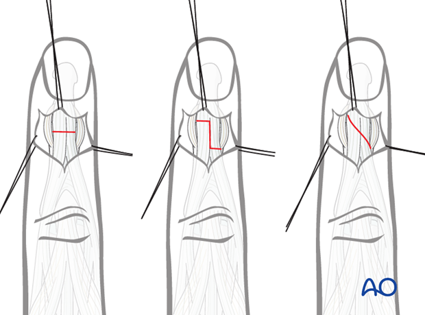 Dorsal approach to the DIP joint
