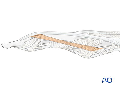 Dorsal approach to the DIP joint