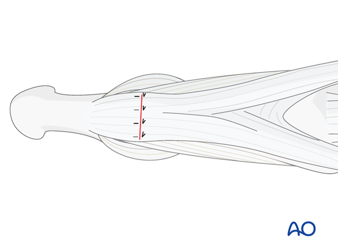 Dorsal approach to the DIP joint
