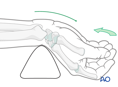 Minimally invasive palmar approach to the scaphoid