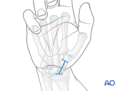 Minimally invasive palmar approach to the scaphoid
