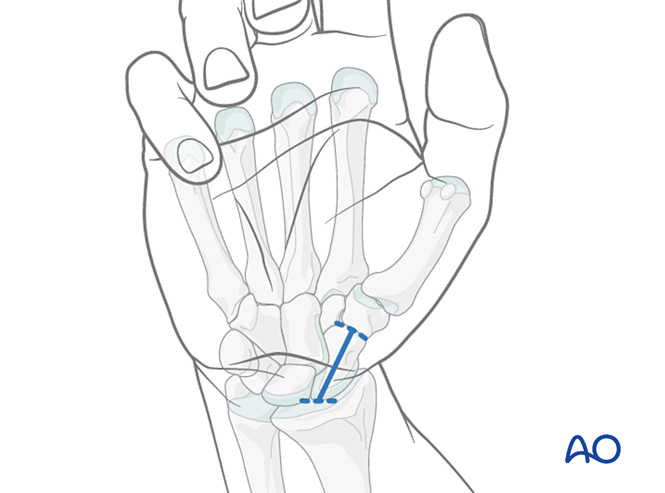 Minimally invasive palmar approach to the scaphoid