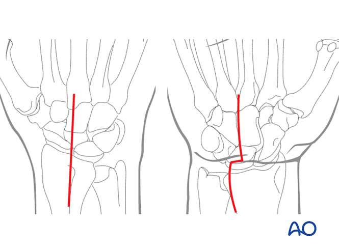 Open reduction - Ligament repair for Lunate dislocation