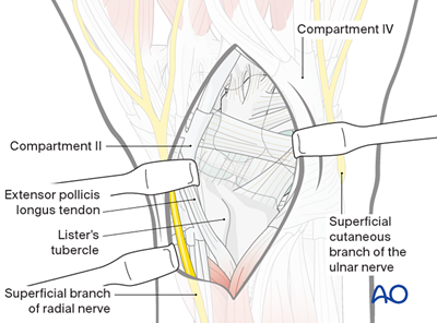 Combined approach to perilunate fractures and dislocations