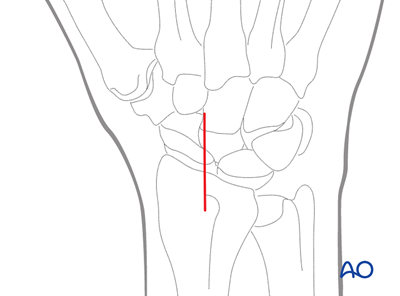 Dorsal approach to the scaphoid