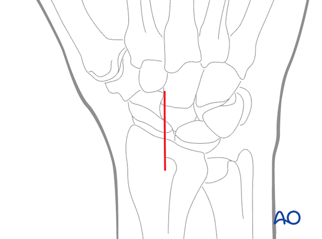 Dorsal approach to the scaphoid