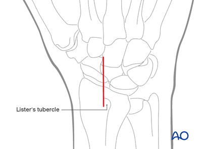 Dorsal approach to the scaphoid