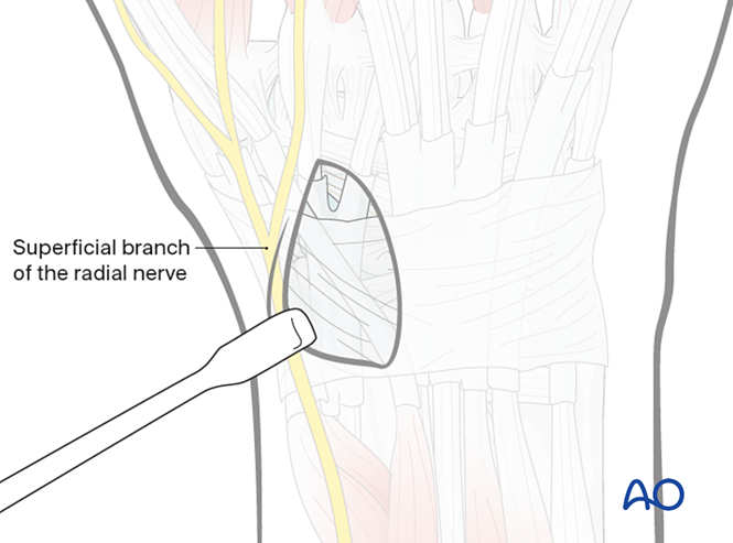 Dorsal approach to the scaphoid