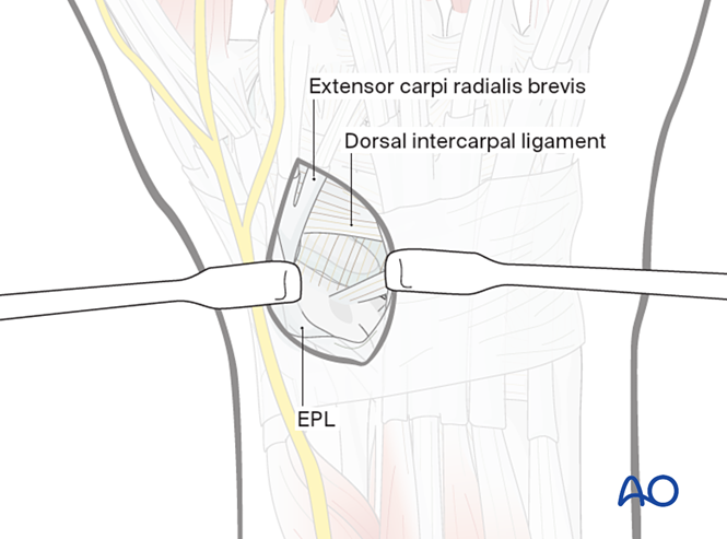 Dorsal approach to the scaphoid