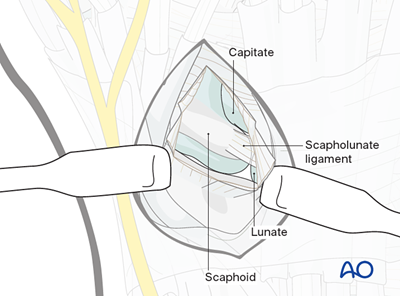 Dorsal approach to the scaphoid