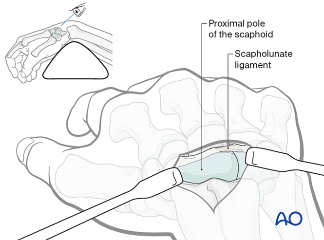 Dorsal approach to the scaphoid