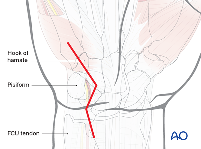 Hook excision for Hamate hook fracture