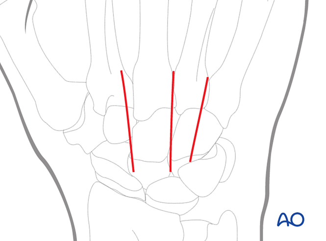 All approaches to the metacarpals