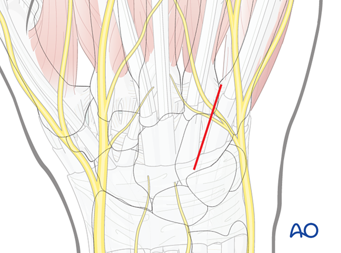 Dorsal approach to the carpometacarpal joint