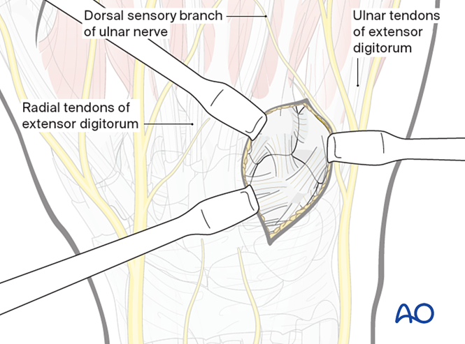 Dorsal approach to the carpometacarpal joints