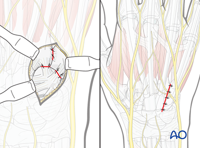 Dorsal approach to the carpometacarpal joints