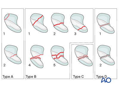Classifications for fractures of carpal bones