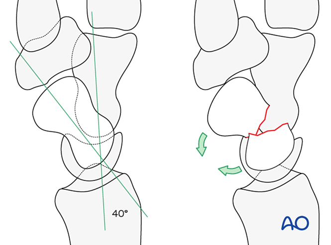 ORIF through dorsal approach - Antegrade screw fixation for Scaphoid ...