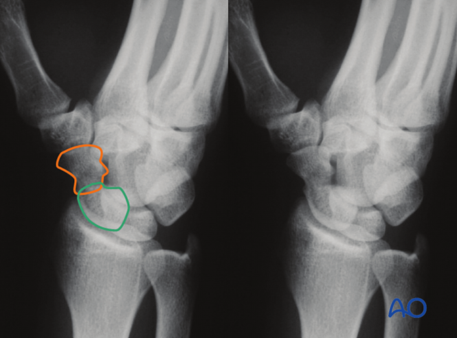 Scaphoid waist fracture