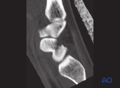 ORIF through dorsal approach - Antegrade screw fixation for Scaphoid ...