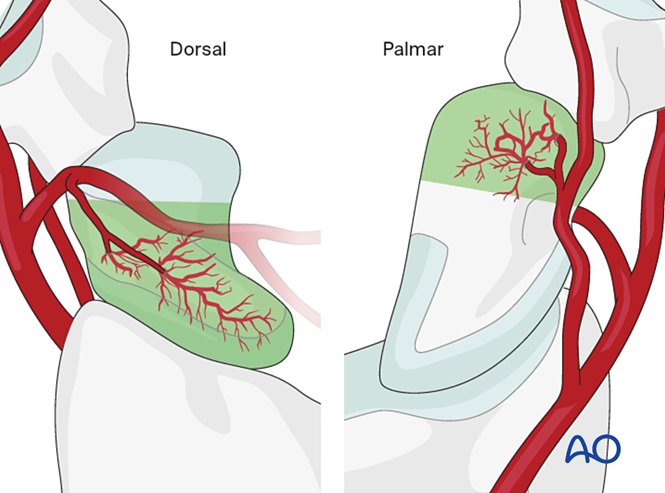 Scaphoid waist fracture