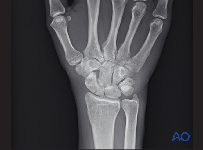 Proximal pole fracture of the scaphoid