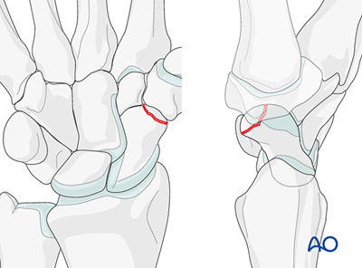 Scaphoid tubercle fracture