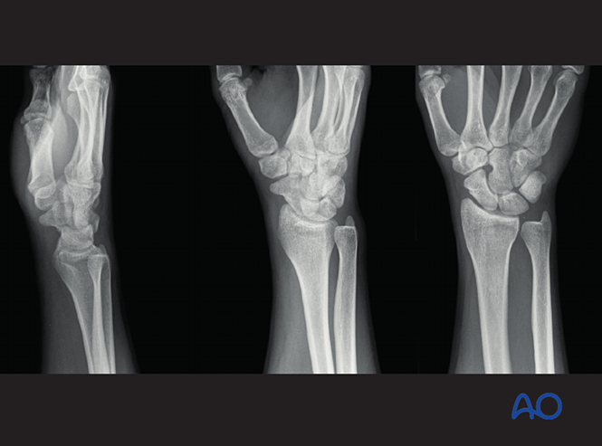 Scaphoid tubercle fracture