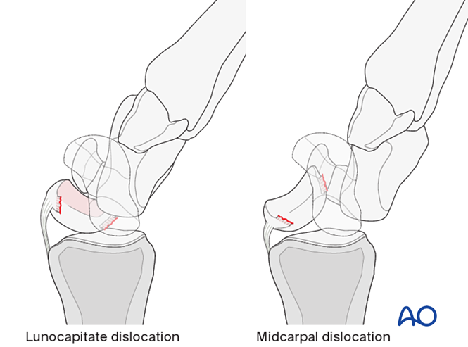 Lunocapitate and midcarpal dislocation