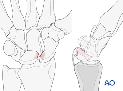Lunocapitate and midcarpal dislocation