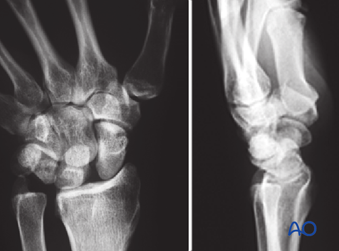 Lunocapitate and midcarpal dislocation