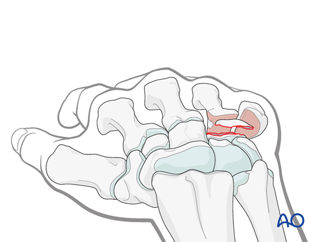 Dislocation and fracture-dislocation of the carpometacarpal joints
