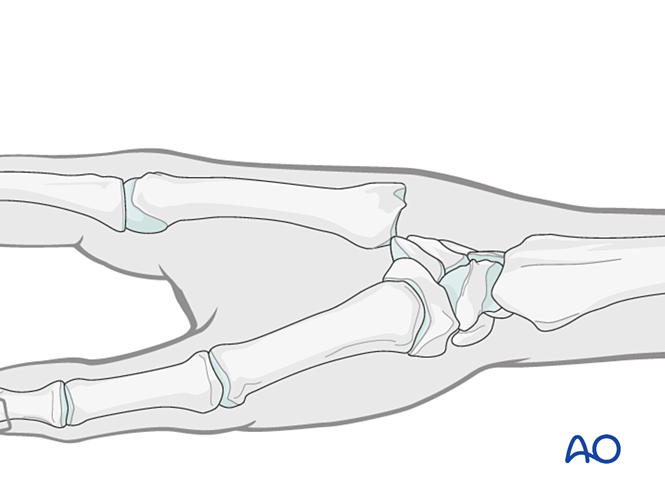Dislocation and fracture-dislocation of the carpometacarpal joints