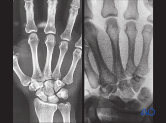 Dislocation and fracture-dislocation of the carpometacarpal joints