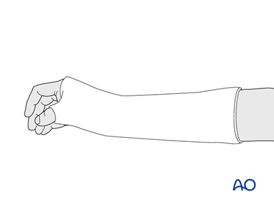 ORIF for Greater arc injury/perilunate fracture-dislocation